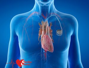 Understanding Atrial Fibrillation